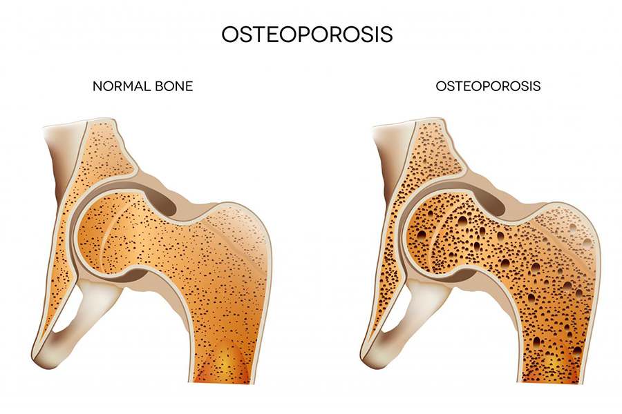 Osteoporosis: causes, symptoms and treatment - BackPainSources