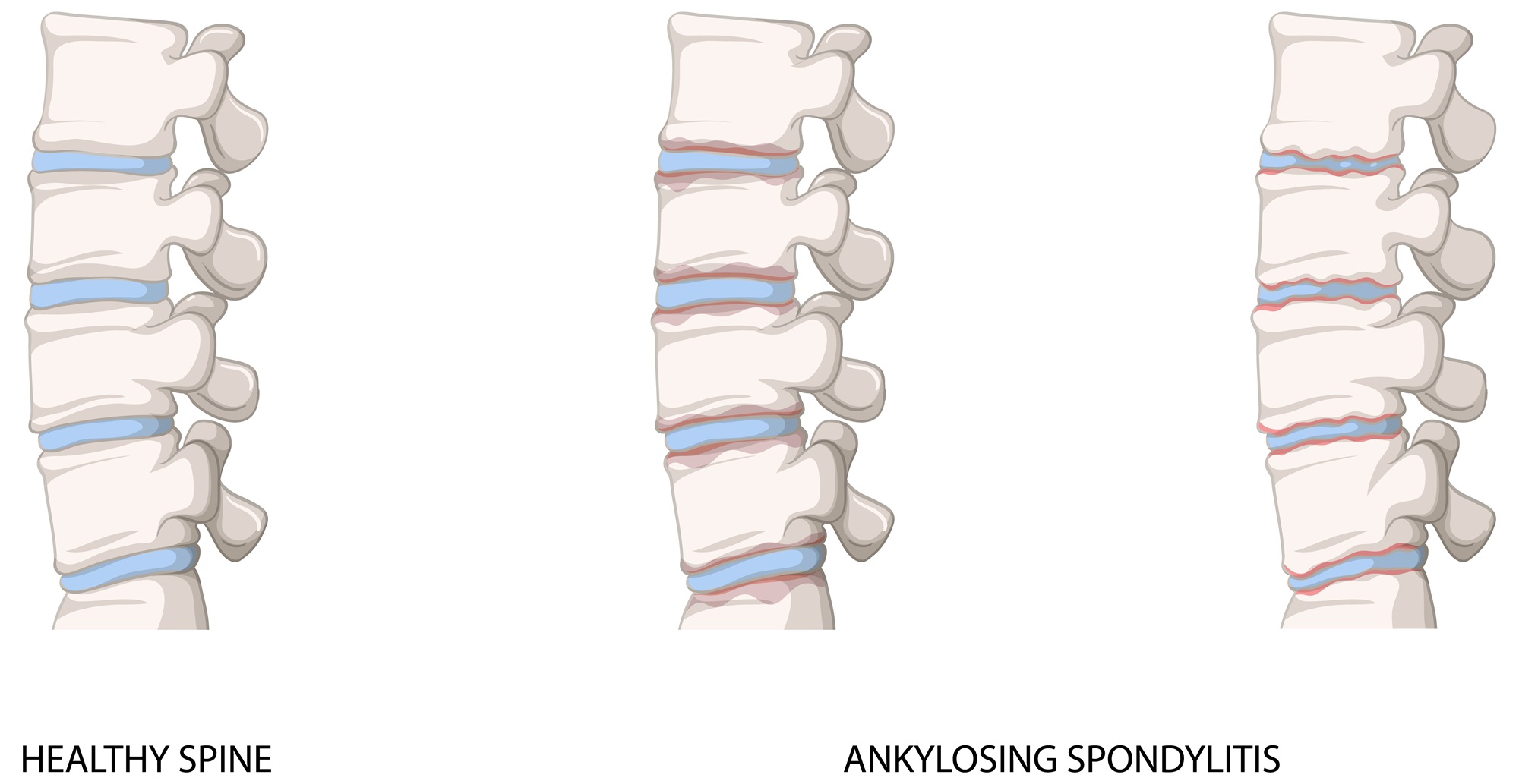 Tests for Ankylosing Spondylitis: How to Detect It - BackPainSources